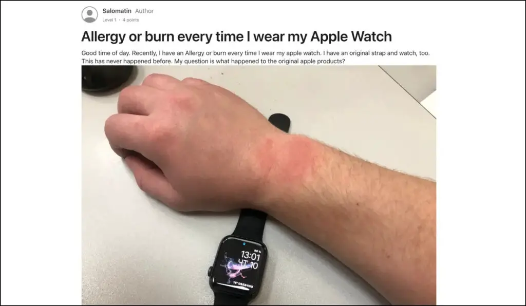 8 Ways to Avoid Rashes or Burns from Your Smartwatch or Fitness Band