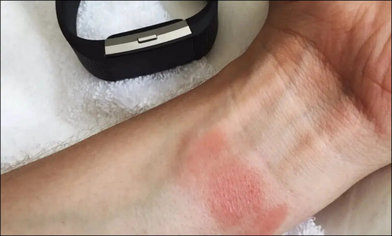8 Ways to Avoid Rashes or Burns from Your Smartwatch or Fitness Band